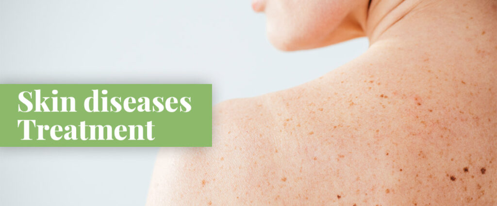 Skin Disease - Shree Vishwa Swasthya Ayurveda